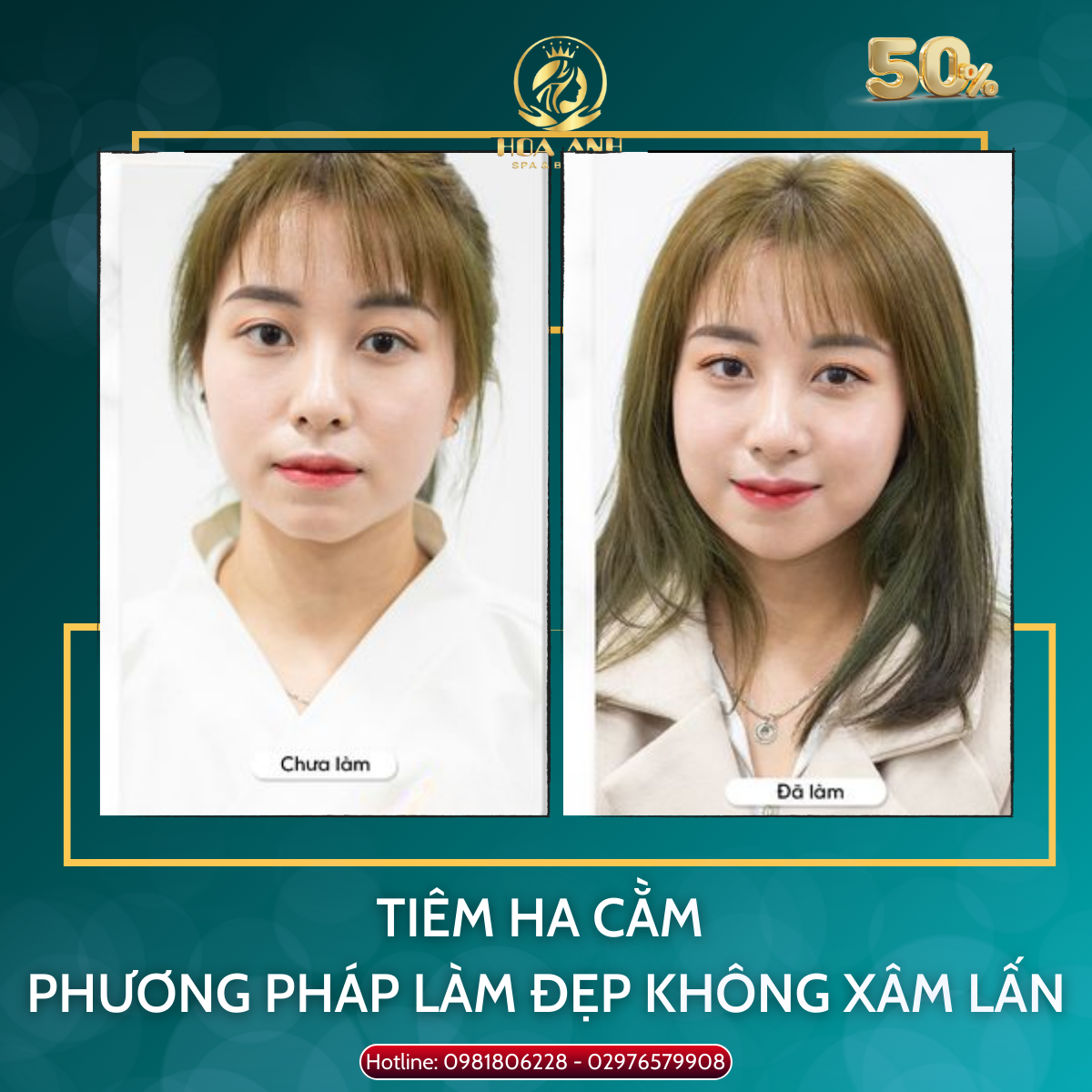 How long after chin filler injection is stable? in kieng giang